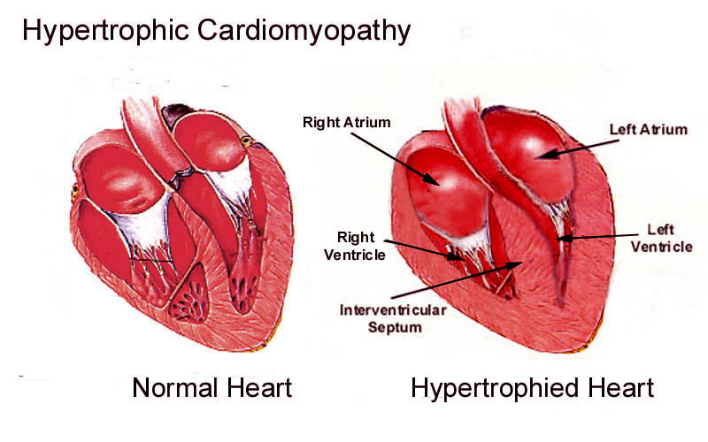 Hypertrophic Cardiomyopathy Causes Symptoms Treatment Hypertrophic Cardiomyopathy Causes Symptoms Treatment